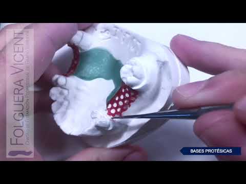 Estructura en cera de una prótesis dental metálica - YouTube