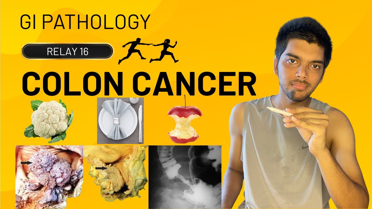 COLON CANCER - GI Pathology 16 - Intestine - Systemic Path Series - YouTube