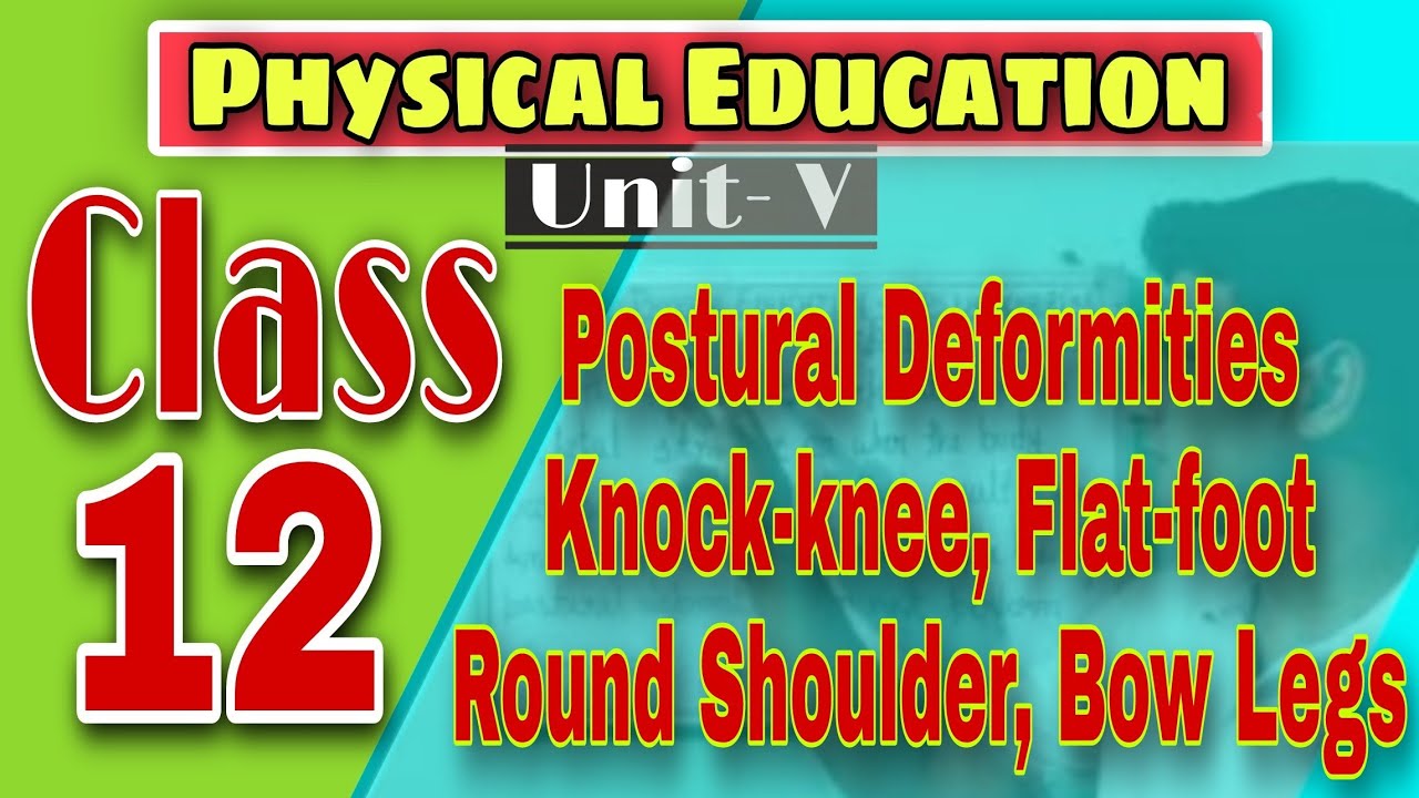 Common Postural Deformities, Flat-foot, Knock knees, Bow-leg, Round ...