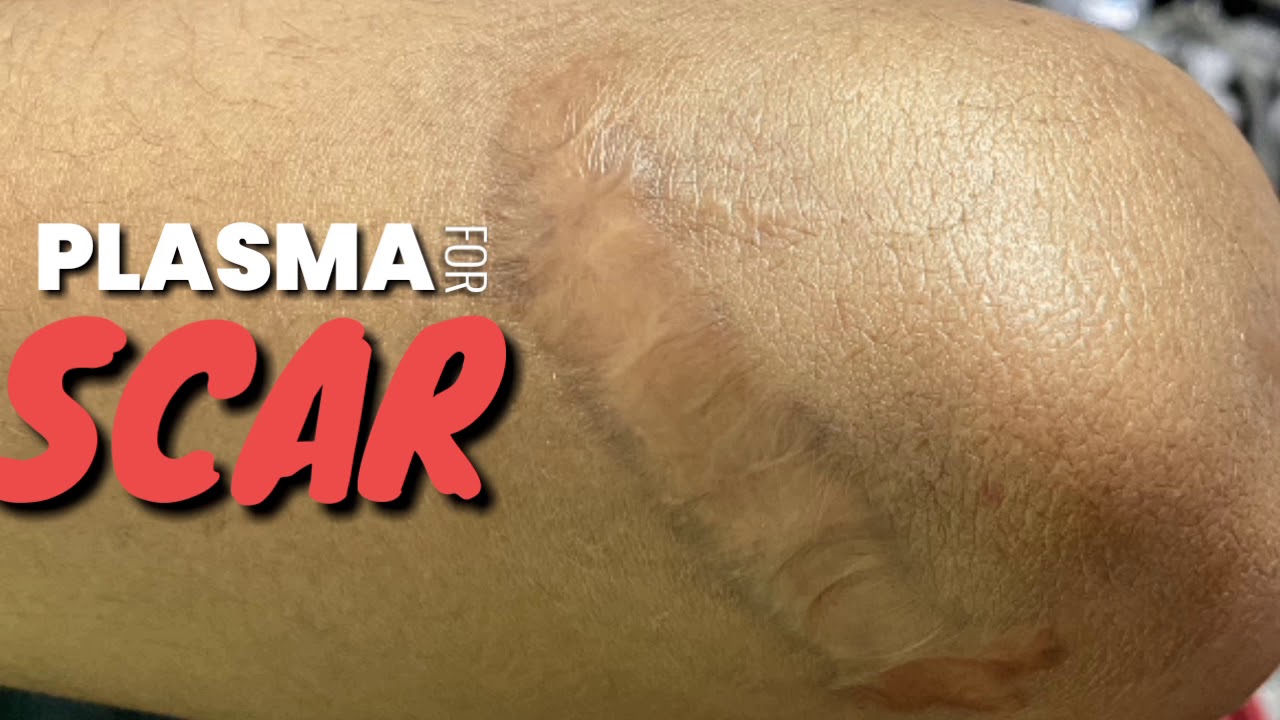Plasma For Scar - YouTube