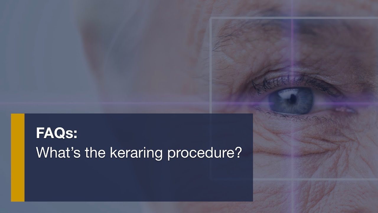 What's the keraring procedure? - YouTube