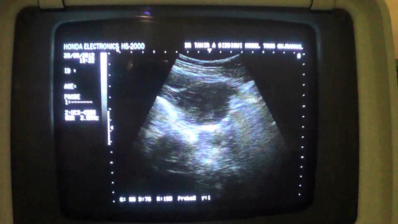 hudge complicated OVARIAN CYST with subserosal uterine fibroid - YouTube