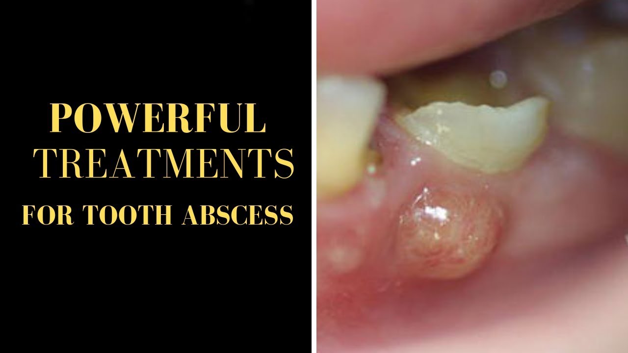 (Tooth Abscess Treatment) GOLDEN TECHNIQUE TO CURE TOOTH ABSCESS ...