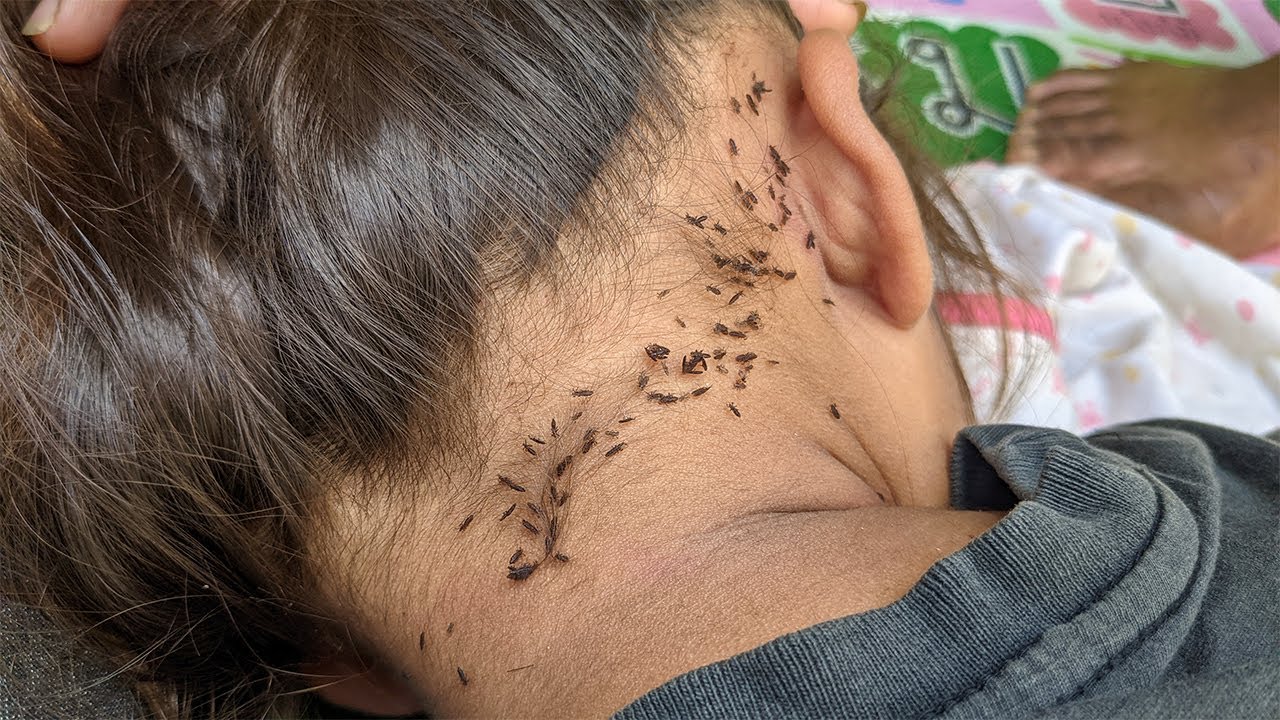 Take out a lot of head lice at home - Comb a thousand head lice from ...