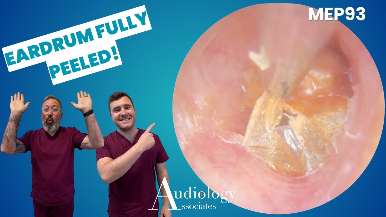 Thick Ear Wax Plug + Full Eardrum Peel – Deep Ear Wax Removal! - M93 ...