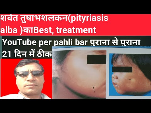 pityriasis alba //treatment//Dermatitis//medicine #pintu,medicine ...