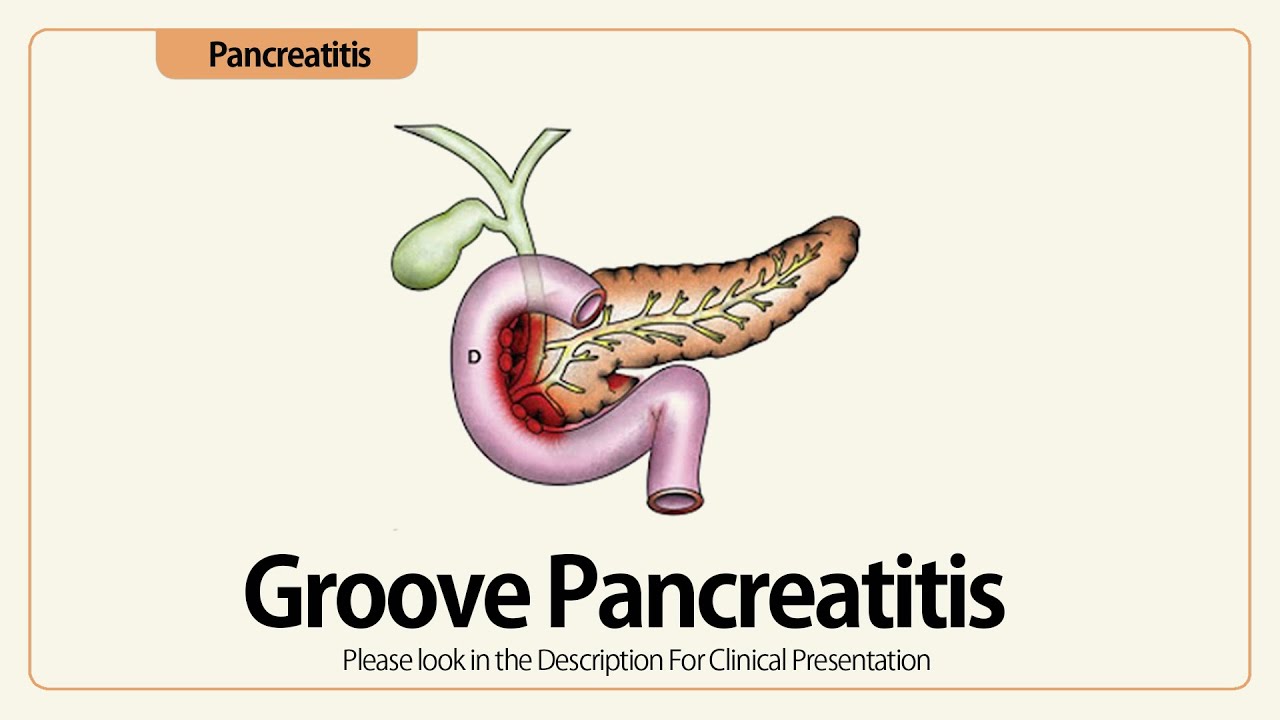 Linear EUS: Groove Pancreatitis - YouTube