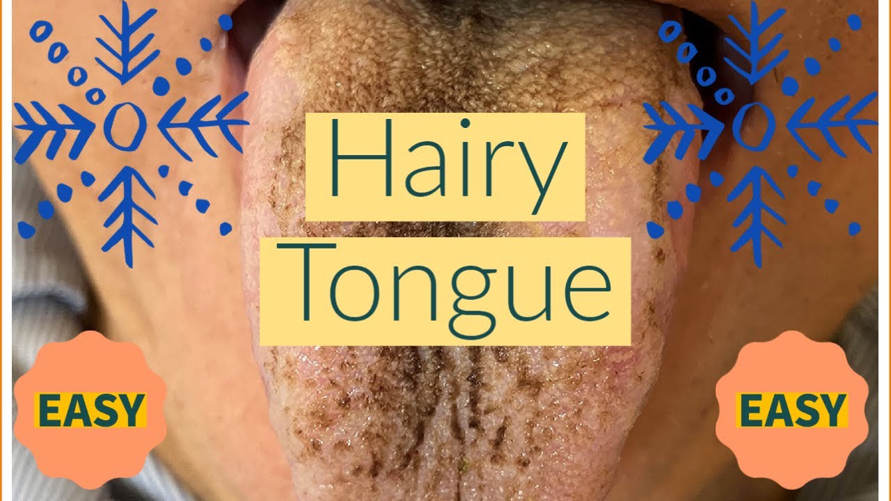 Hairy Tongue (EASY) - YouTube