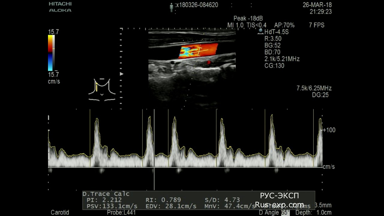 Сосуды УЗИ Hitachi Arietta V70 - YouTube