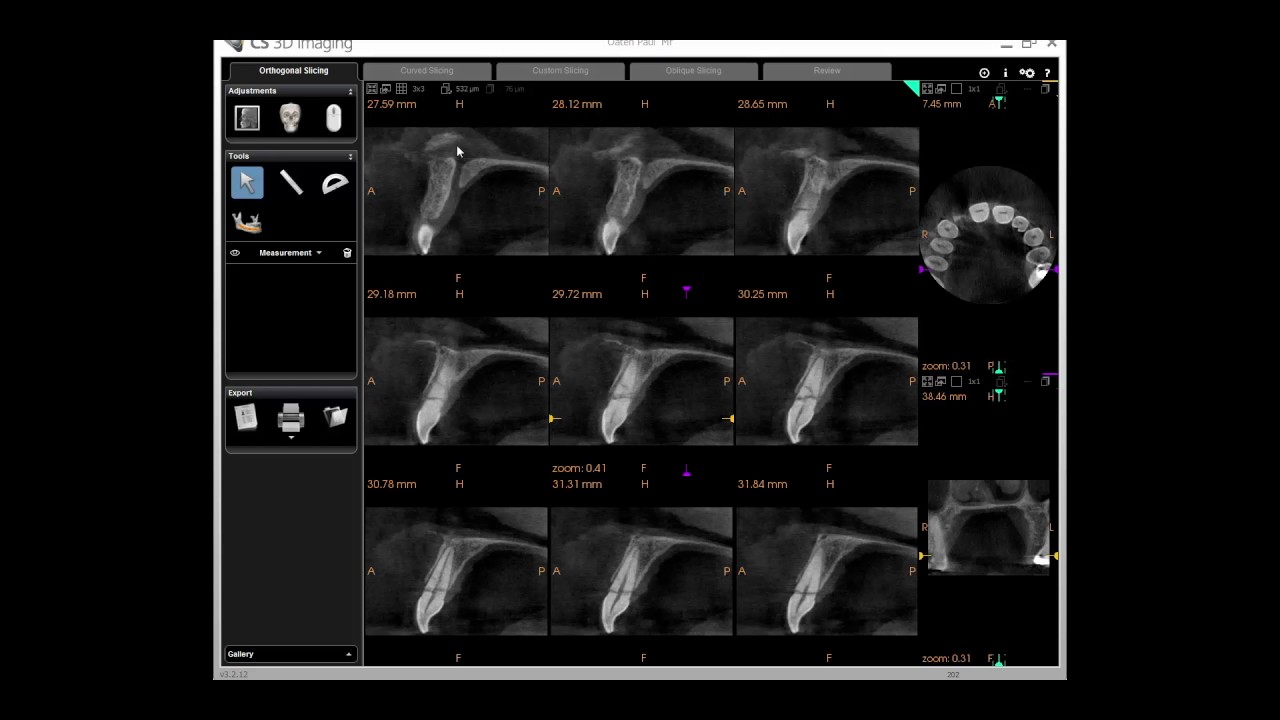 Reporting a Carestream CBCT Scan CS Imaging - YouTube