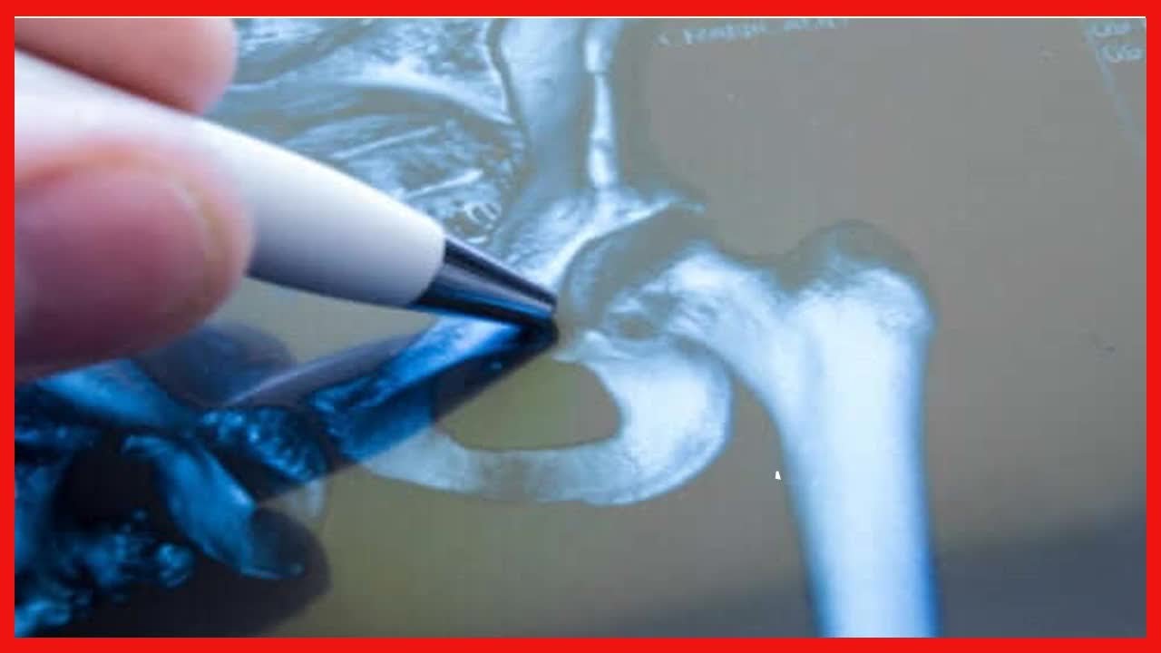 Fracture de la hanche : tout ce qu'il faut savoir - YouTube