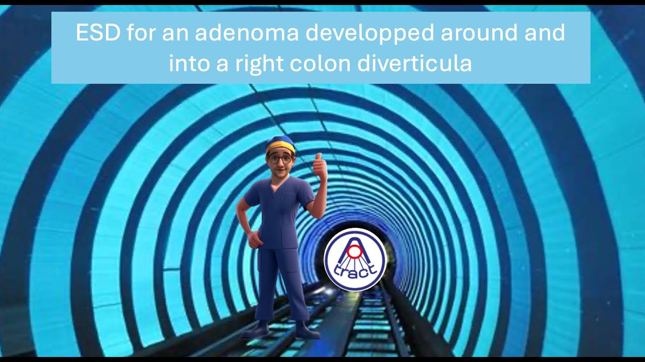 ESD school colon diverticula complete - YouTube