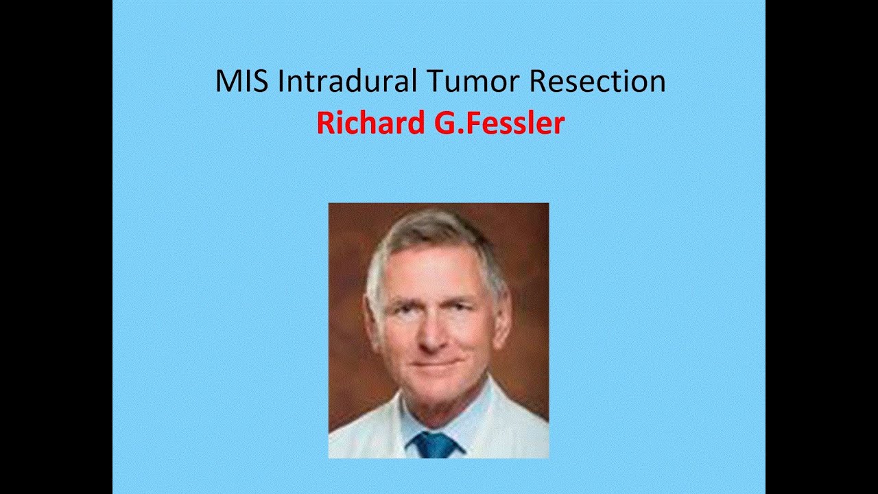 WFNS Spine Committee Symposia: Richard Fessler: MIS Intradural Tumor ...