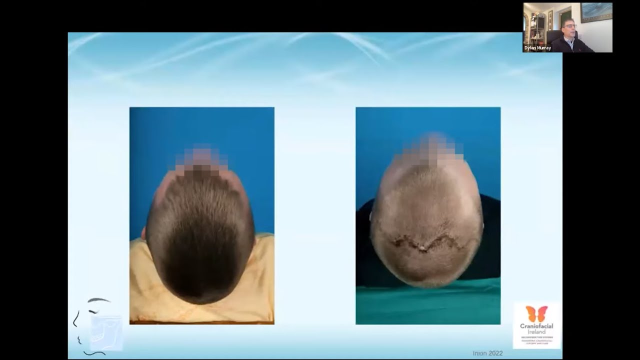 Inion Webinar: Dr. Dylan Murray - Pediatric Cranioplasty with the Inion ...