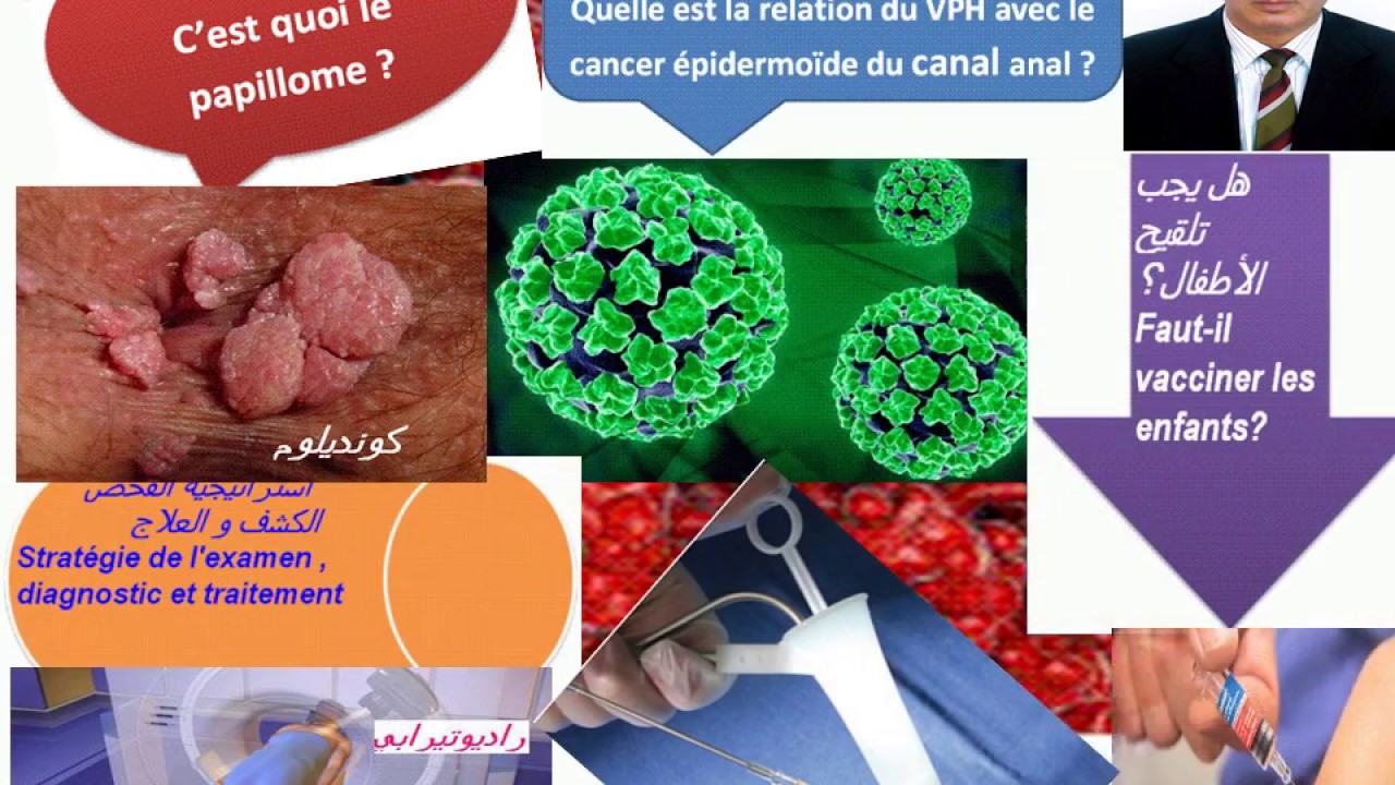 Papillome humain , condylome , crête de coq gastro casa procto casa ...