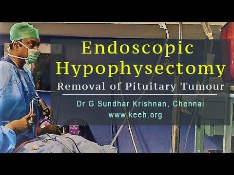 Removal of Pituitary Tumour via the nose - Dr G Sundhar Krishnan ...