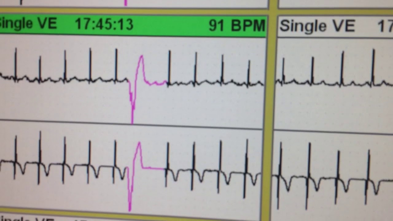 ECG 11.1 HOLTER CON EXTRASISTOLES VENTRICULARES BIGEMINADAS Y PAREADAS ...