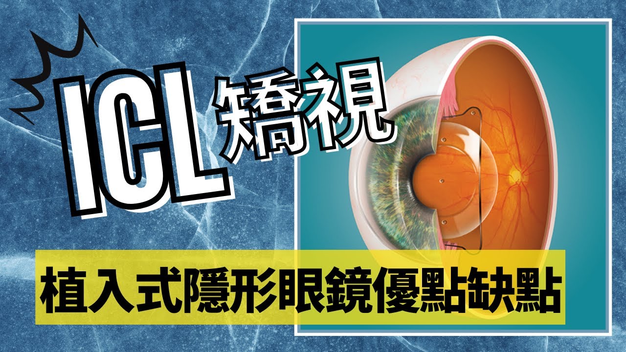 [ICL矯視] icl植入式隱形眼鏡 手術 優點 缺點 後遺症 副作用 lasik smile 比較 icl vs iol 白內障手術 近視 ...