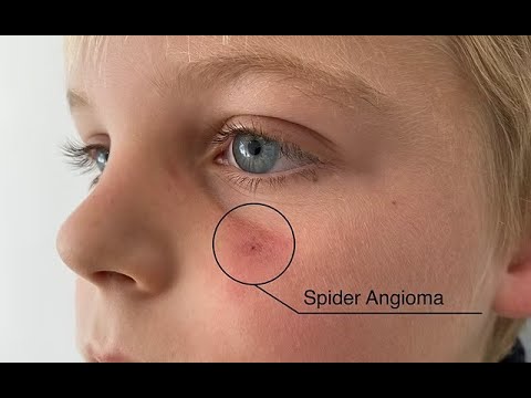 Spider angiomas Or spider naevi or spider telangiectasias Or Blood ...