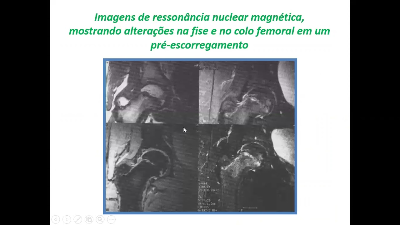 Aula de Epifisiólise Femorala Proximal e Deformidades em Ortopedia ...