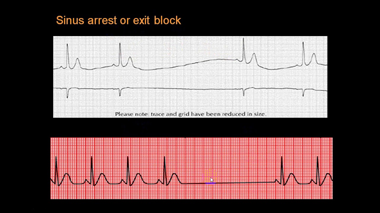 EKG CONDUCTION BLOCKS - YouTube