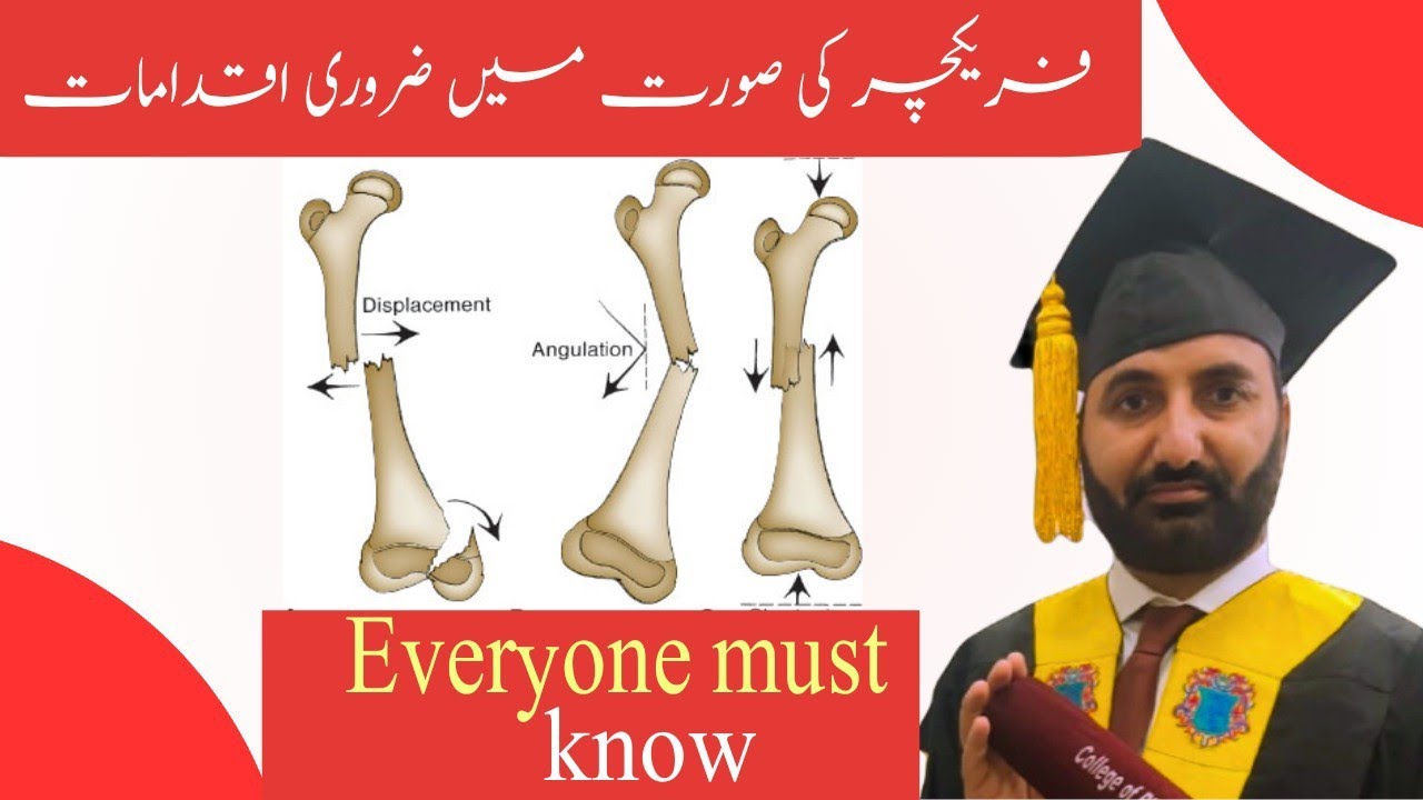 Haddi toot jaye tu kia Karen|Emergency steps after fracture| haddiyon ...