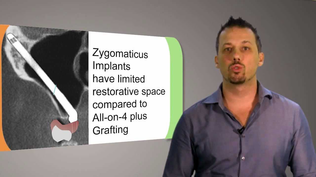 What are Zygomatic Implants (AKA Zygoma / Cheekbone Implants -- CAID ...