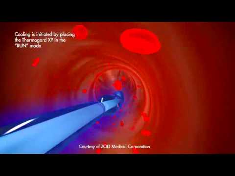 ZOLL IVTM animation - YouTube