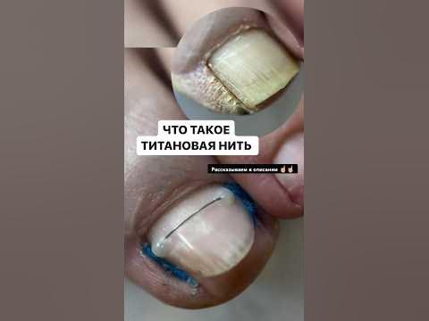 Какие есть показания для установки титановой нити? Читайте в описании к ...