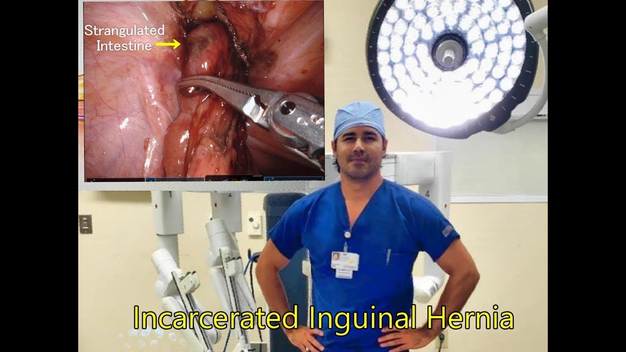 Incarcerated Inguinal Hernia Repair, Strangulated Hernia, Indocyanine ...