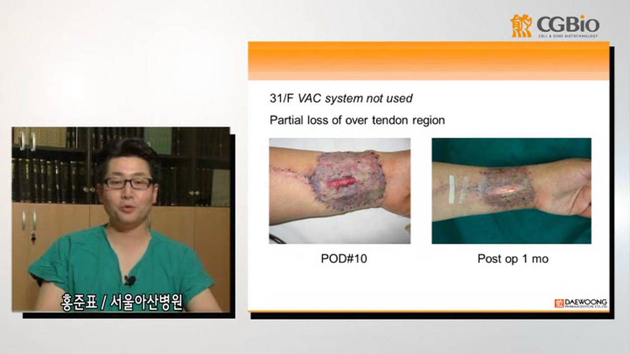 NPWT_Efficacy of CuraVAC KOR ver - YouTube