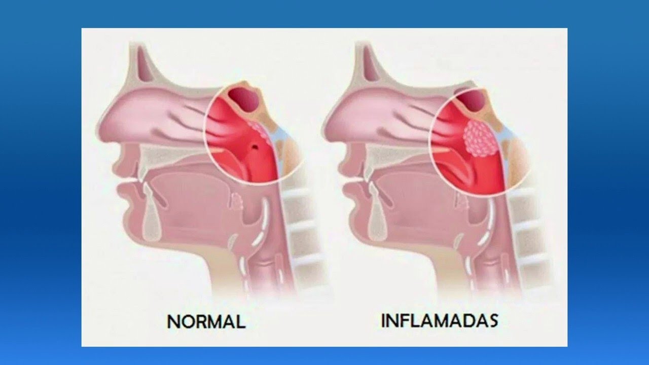 ¿Cuáles son las causas de las adenoides? - YouTube