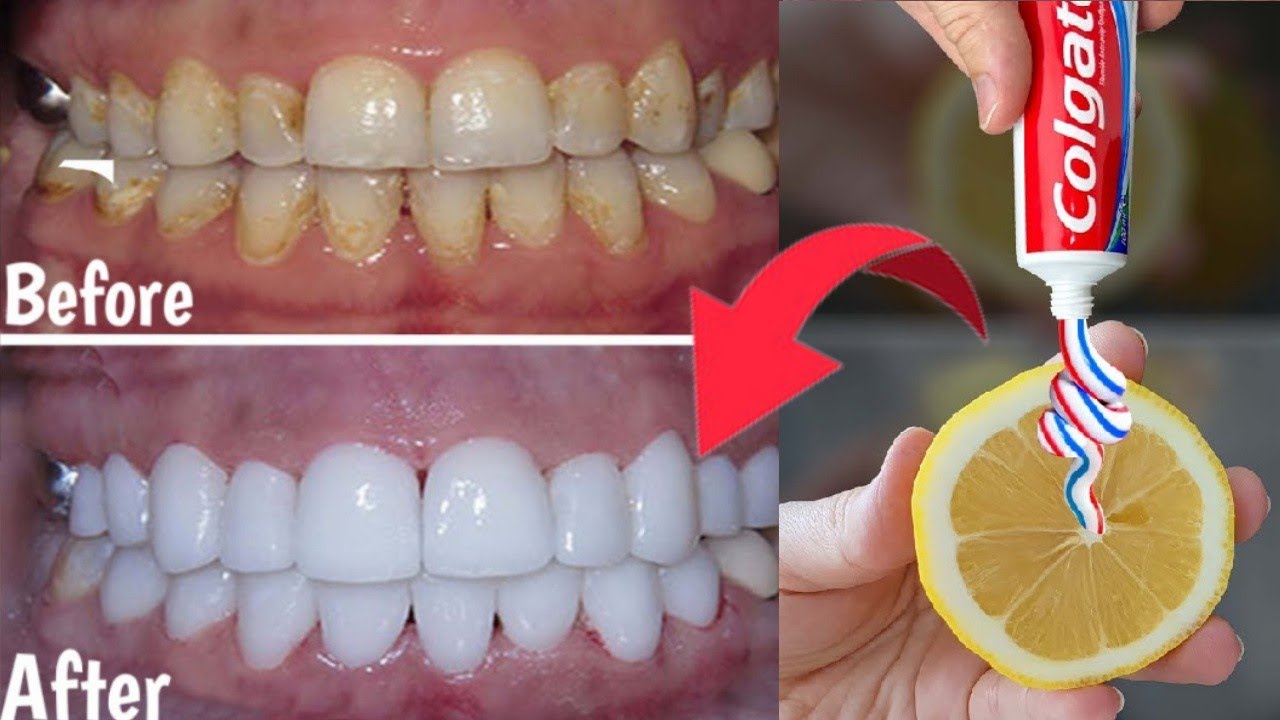 Natural mixture for yellow teeth whitening at home in one day without a ...