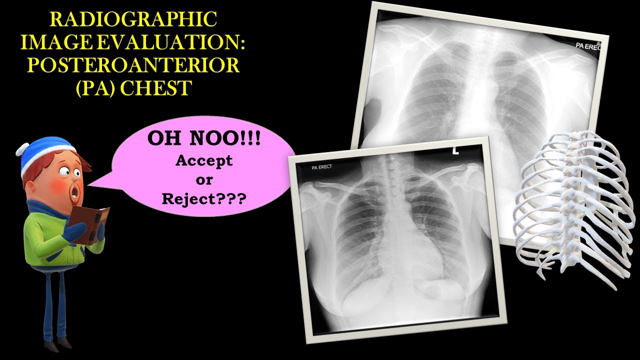 Image Evaluation of PA chest X-ray - YouTube