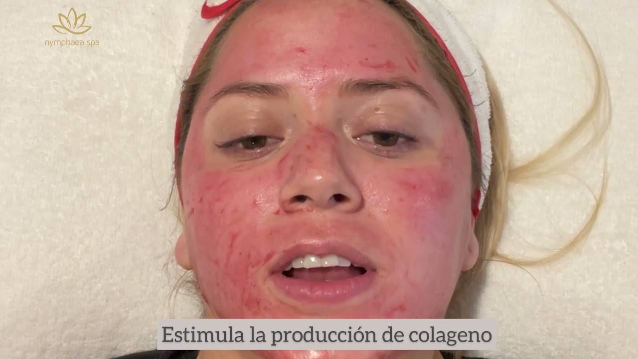 El antes y el después del Dermapen - YouTube