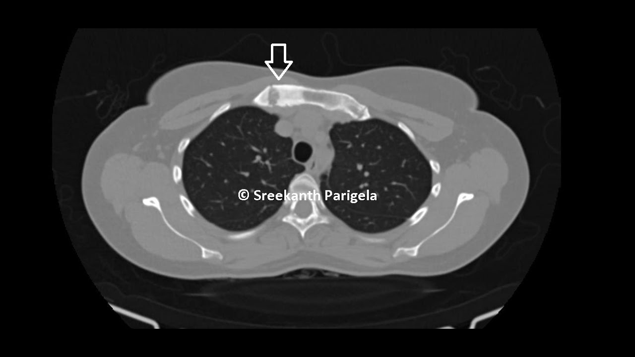 SAPHO syndrome - CT Chest - YouTube