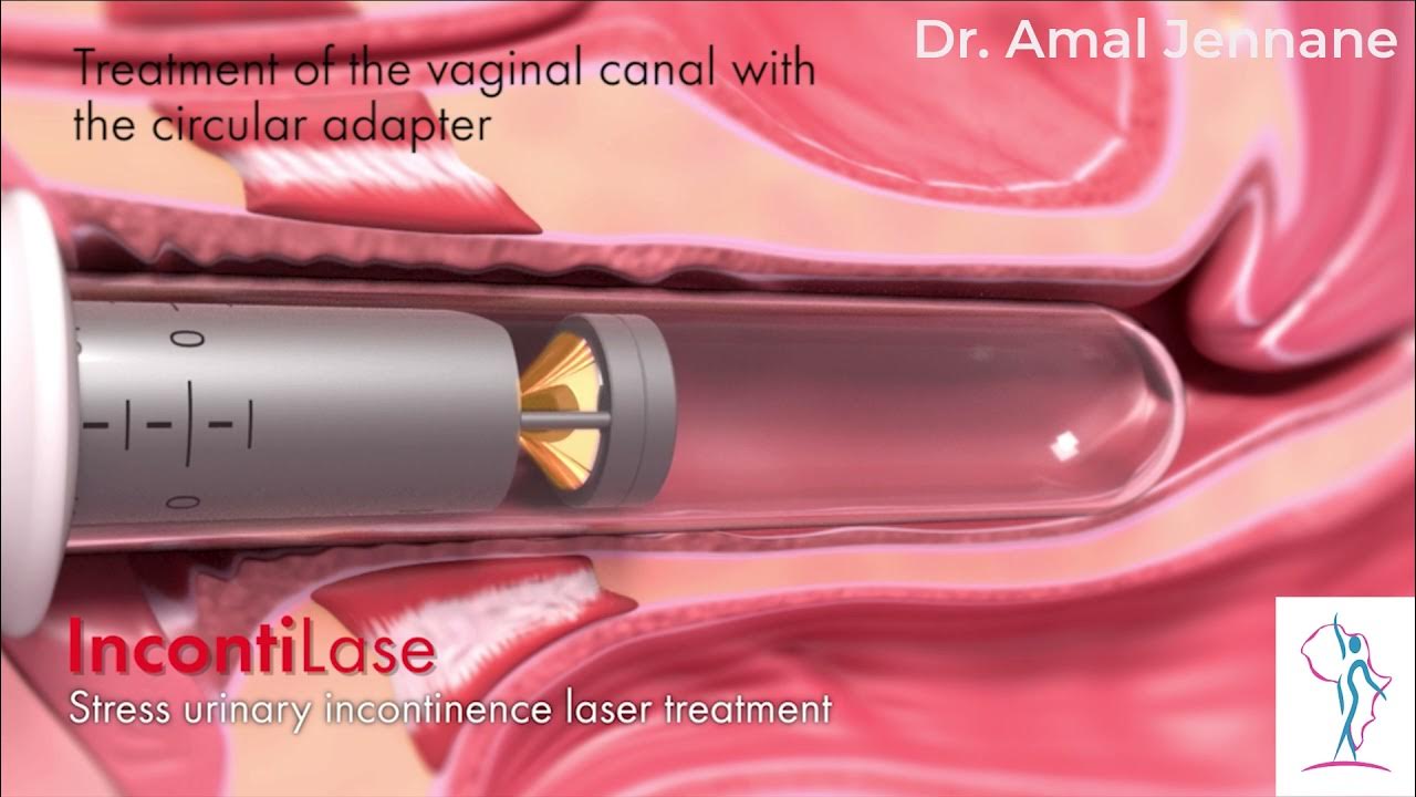 Dr Amal Jennane Resserrement Vaginal Traitement Du Prolapsus Et De L