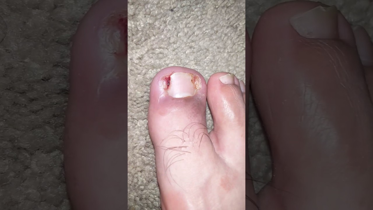 Infected Toe
