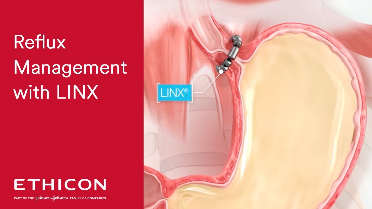 How LINX Works for Reflux Management (GERD) | Ethicon - YouTube