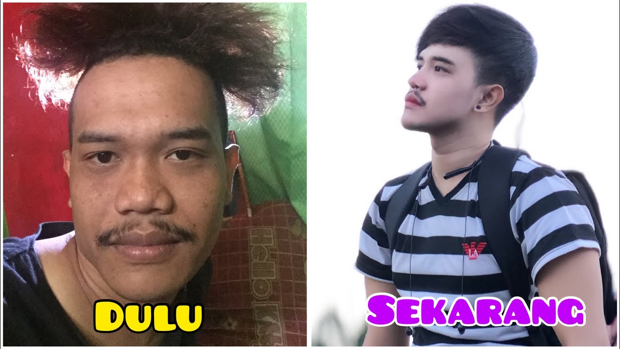 NOSE JOB INDONESIA RHINOPLASTY PLASTIC SURGERY OPERASI HIDUNG INDONESIA ...