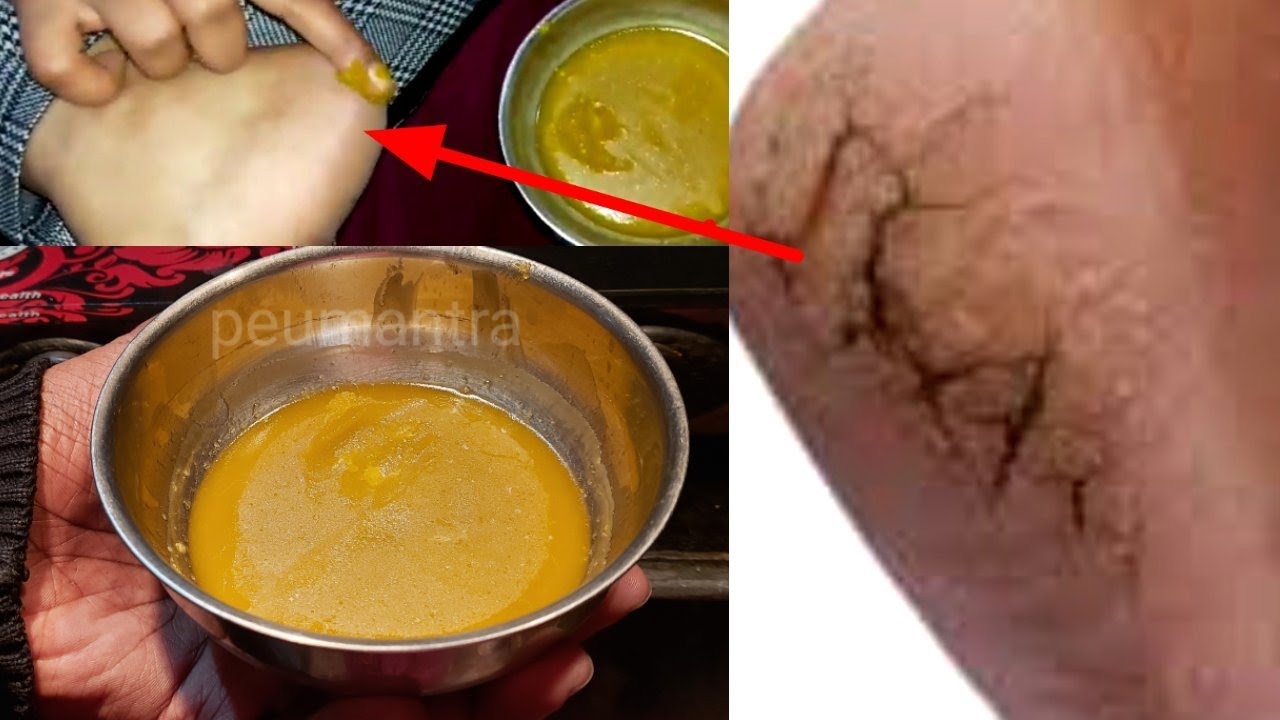 1 रात में फटी एड़ियों को ठीक करे घरेलू उपाय। Cracked Heels Home Remedy ...