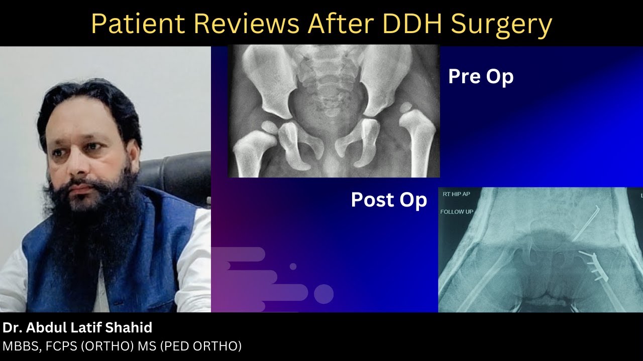 DDH reviews | Patient Reveiws after DDH Surgery | DDH Surgery Outcome ...