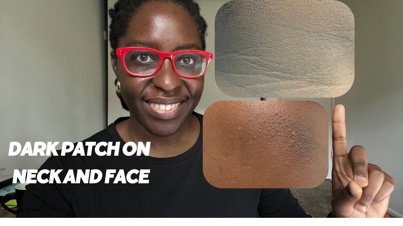 Acanthosis Nigricans: The Skin Condition That Warns You About Diabetes ...