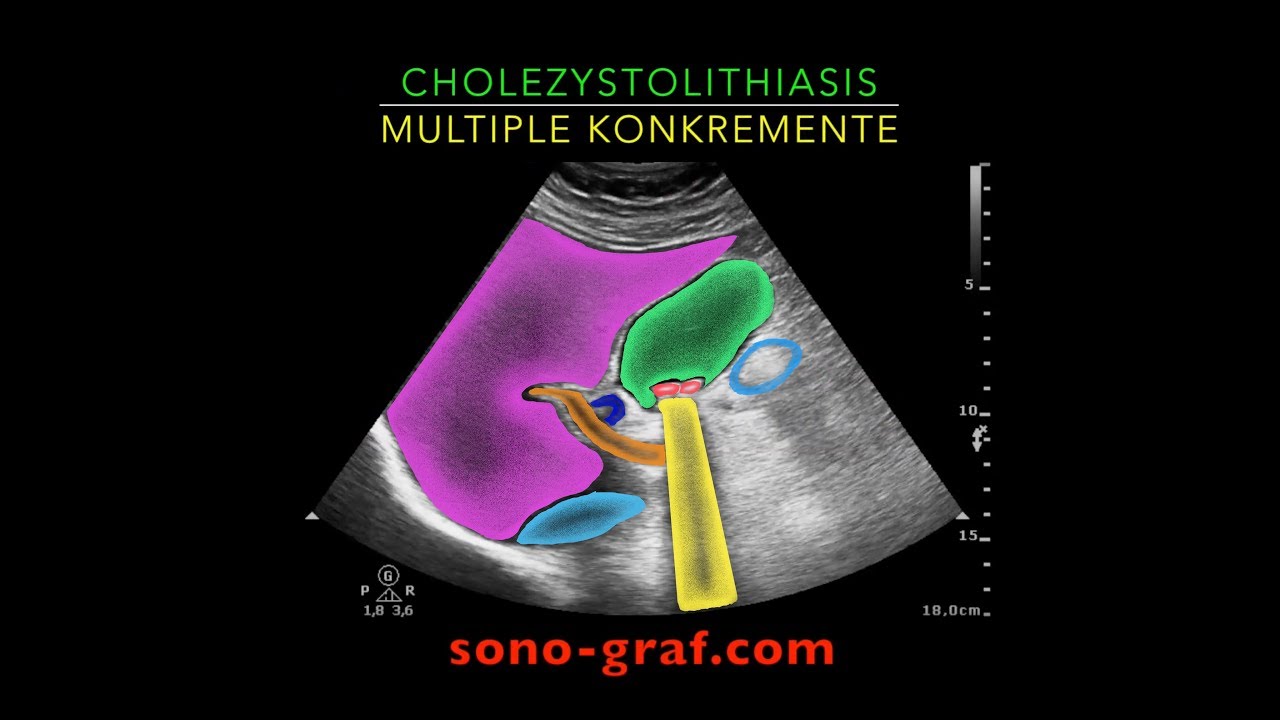 003 - Sonografie - Cholezystolithiasis - YouTube