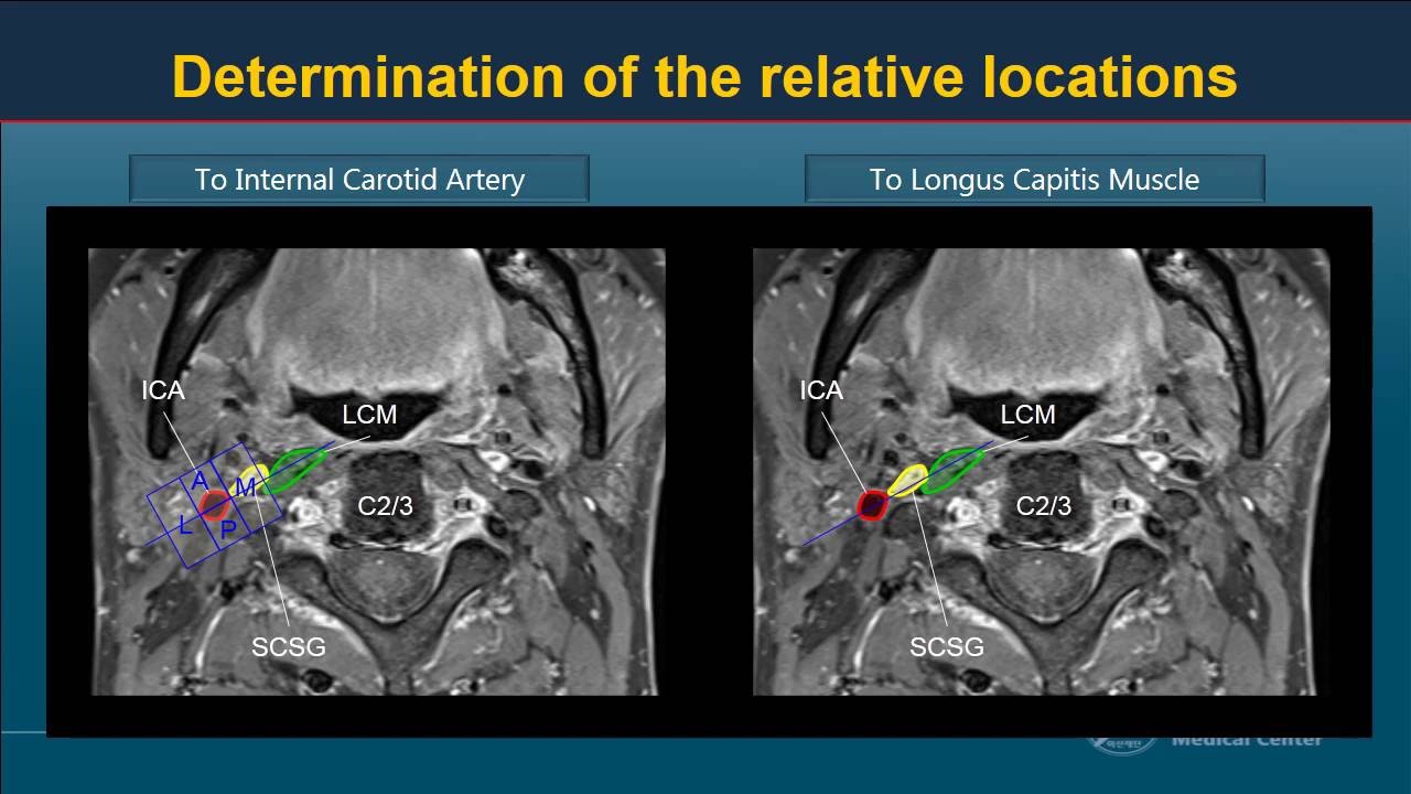Superior Cervical Ganglion Anatomy