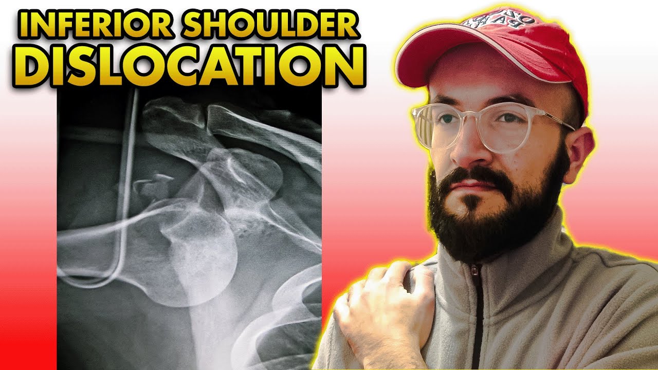 Inferior Shoulder Dislocation: Clinical Features, Imaging, Treatment ...