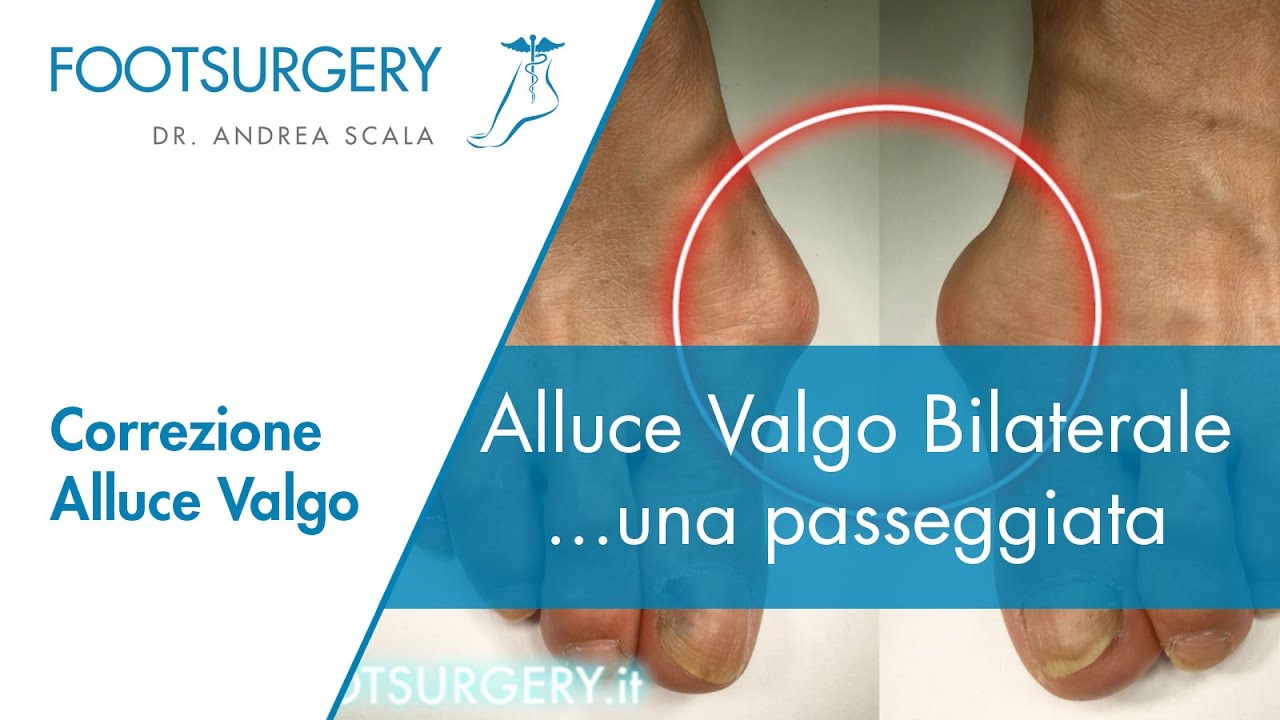 Alluce Valgo Bilaterale, una passeggiata | Alluce valgo prima e dopo ...