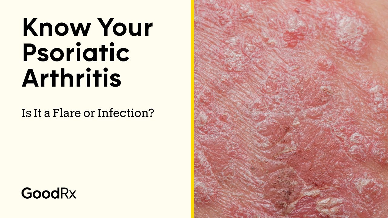 Know Your Psoriatic Arthritis: Is It a Flare or Infection? | GoodRx ...
