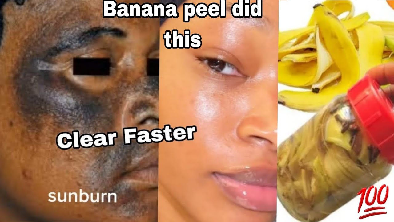 Banana Peels: Clear sunburn like crazy and doesn't fall out! You will ...