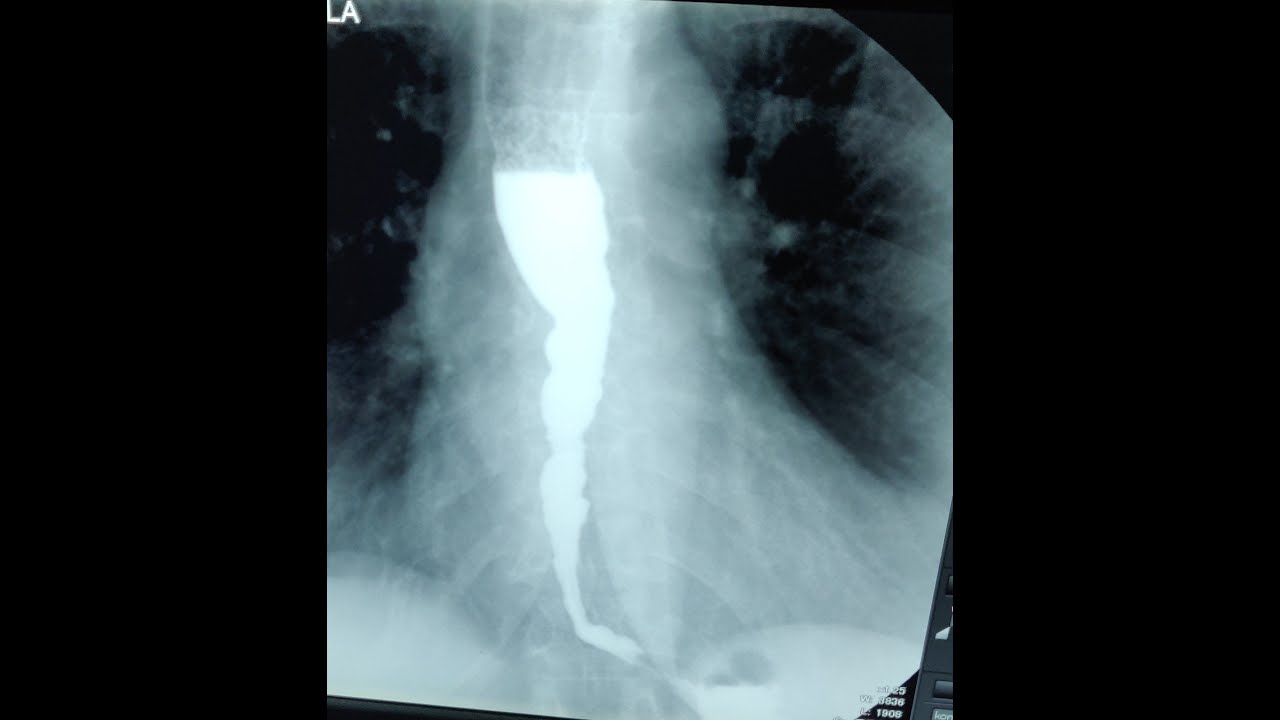 How is Achalasia Cardia Surgery treatment done? / Heller's Cardio ...